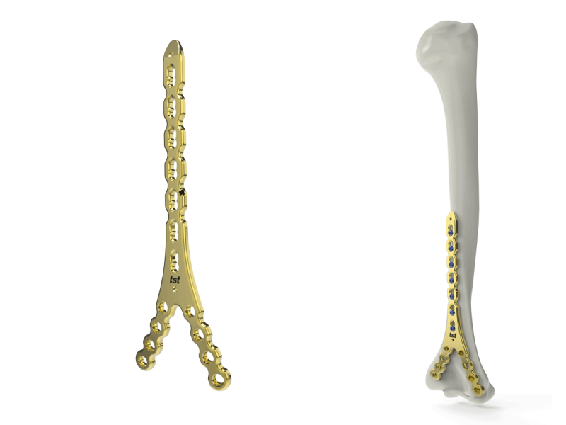 Distal Humerus Locking Y Plates – TST