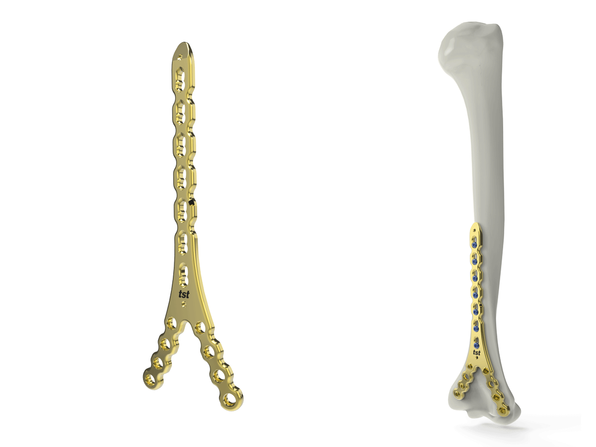Distal Humerus Locking Y Plates – TST