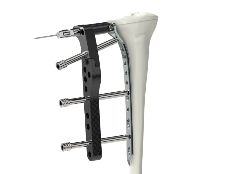 MISS Proximal Tibia Lateral Plates – TST