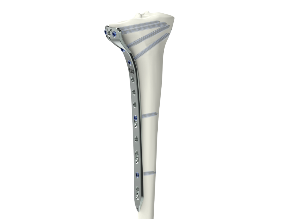 MISS Proximal Tibia Lateral Plates – TST