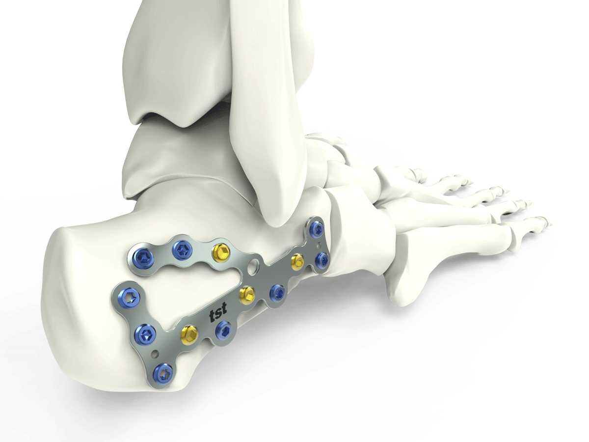 Calcaneus Plates – TST