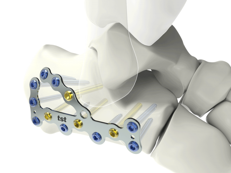 Calcaneus Plates – TST