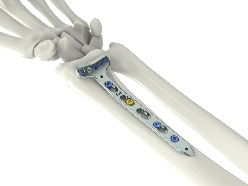 Distal Radius T Plakları (Volar) – TST