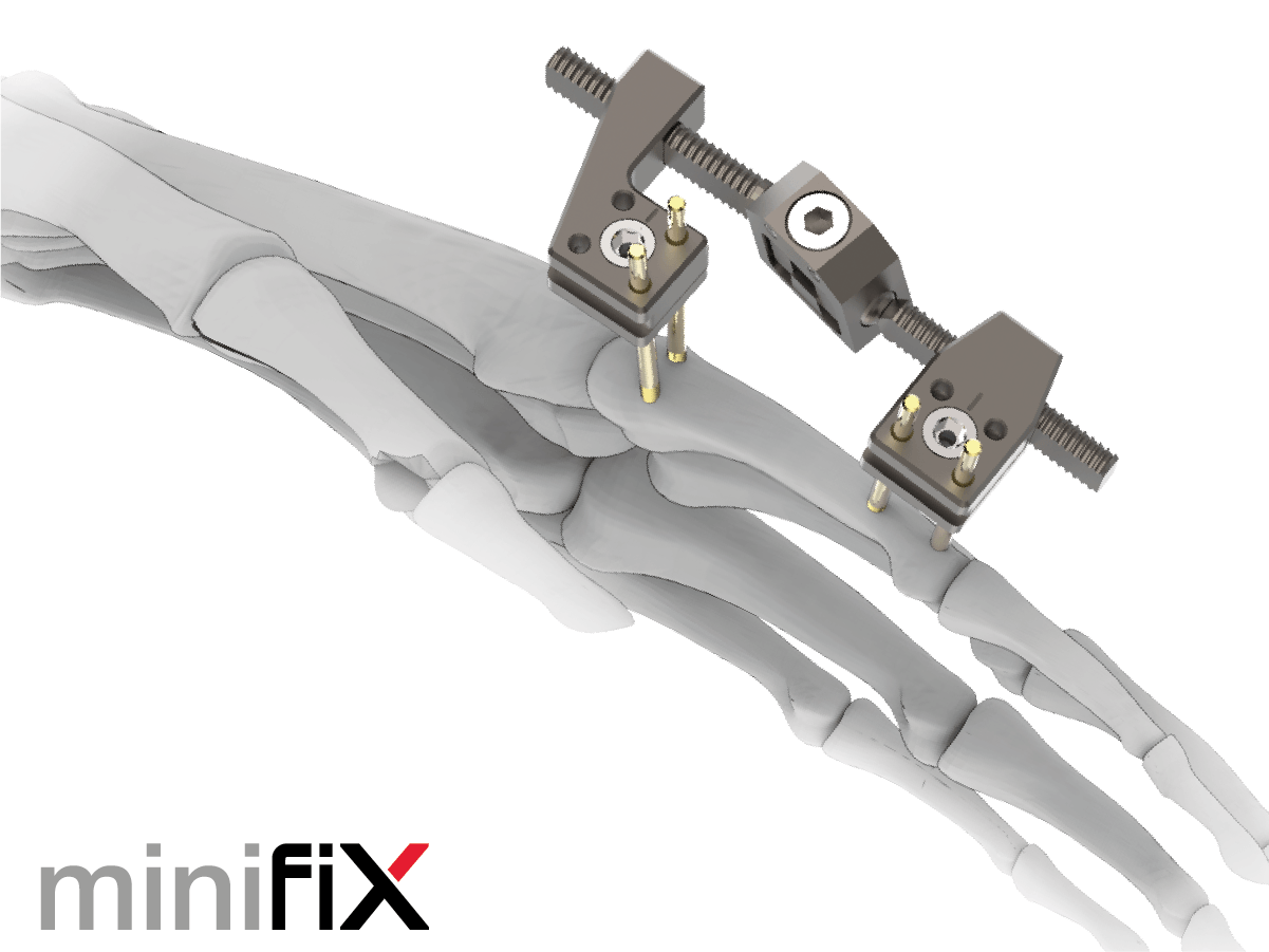 Mini Fixators – TST