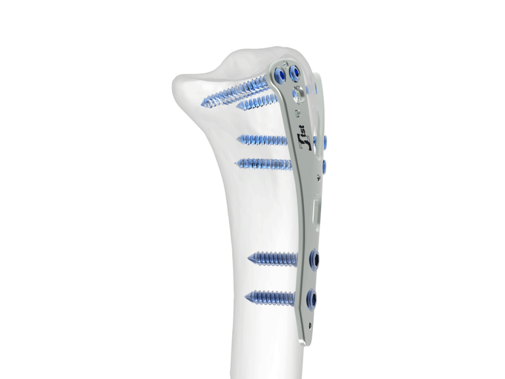 Distal Radius Y Plates (Dorsal) – TST