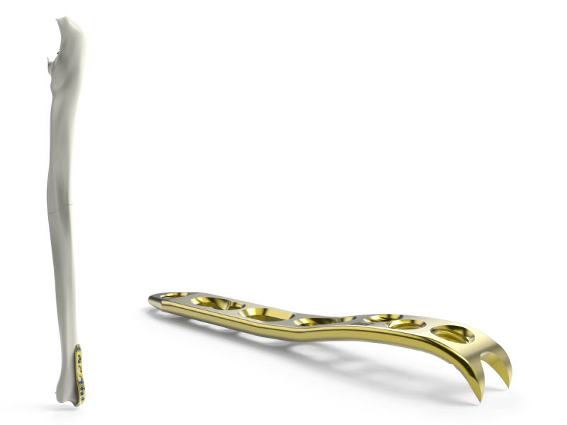Distal Ulna Plates – TST