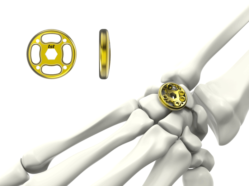 Intercarpal Fusion Plate – TST