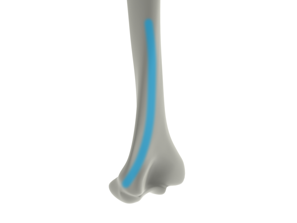 Distal Humerus Posterolateral VAL Plates – TST
