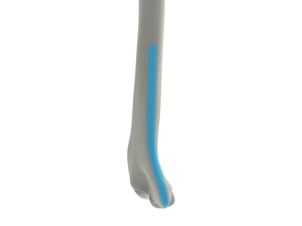 Distal Humerus Medial VAL Plates – TST