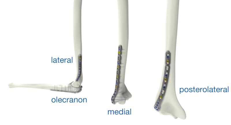 TST – Orthopedic Implants